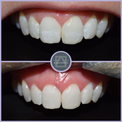 Icon White Spot Treatment | Telford & Shropshire | Twickel Dental